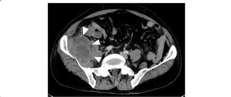 Ct Image Enhanced Computed Tomography Revealed A Heterogeneous