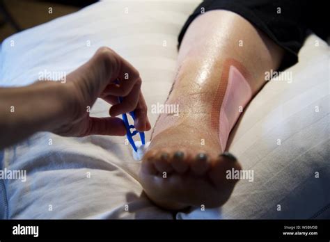 Sterilising A Surgical Wound Prior To Removal Of Staples From A Female Patient Following
