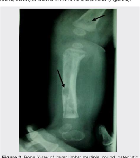 Figure 1 From Disseminated Bcg Infection Revealing A Severe Combined
