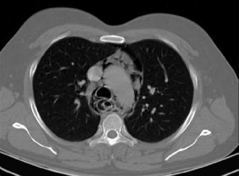 Chest Ct On Admission Demonstrated A Bilateral Pneumothoraces