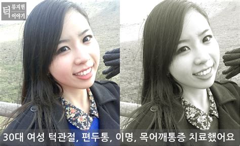 30대 여성 턱관절 두통 이명증 목어깨통증 신경차단술 치료후기 신경차단교근축소술 5개월 뒤 머리가 아픈 것이