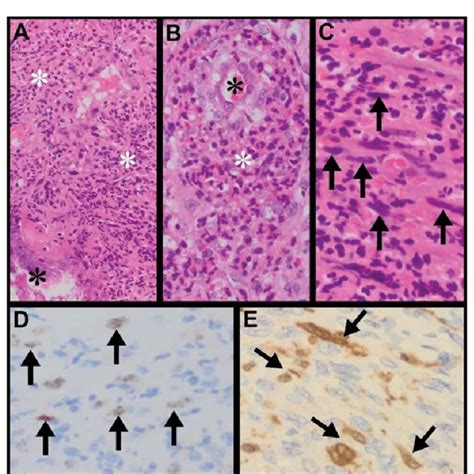 Nodular Kaposi Sarcoma A Composed Of Hyperchromatic Spindle Cells And