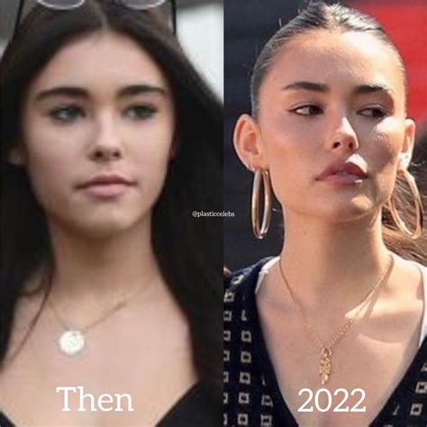 Madison Beer Plastic Surgery In 2022 Madison Beer Plastic Surgery
