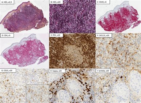 Histological Presentation Of A Primary Cutaneous Marginal Zone Lymphoma