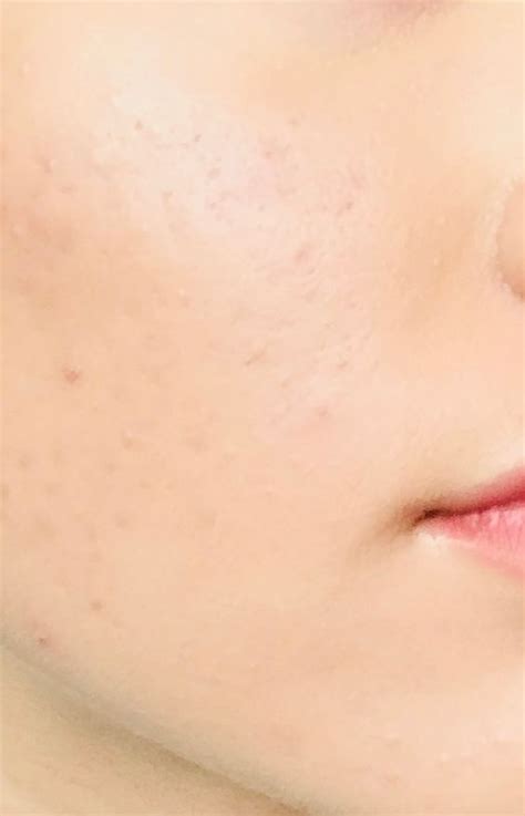 Борьба с акне 1 Очищение Herbomania — Livejournal