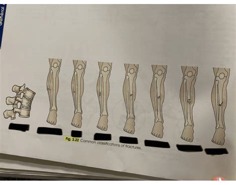 Common Classifications Of Fractures Quiz