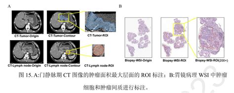 国自然青年基金｜基于机器学习的胃癌辅助化疗疗效预测模型建立及实证研究｜基金申请·25 03 05自然基金 机器学习 Csdn博客