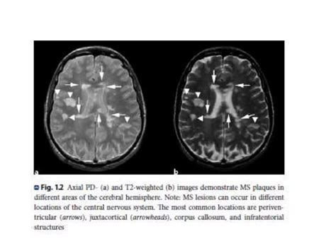 Radiology Of Multiple Sclerosis Pptx