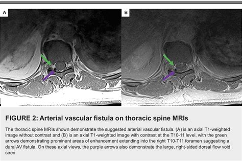 Figure 1 From Surgical Management Of A Spinal Dural Arteriovenous Fistula Semantic Scholar