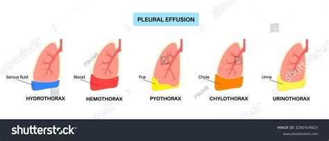 Pleural Effusion Poster Fluid Between Layers Stock Vector Royalty Free
