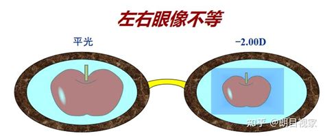 朗目视家 单眼视力差没必要配镜 知乎