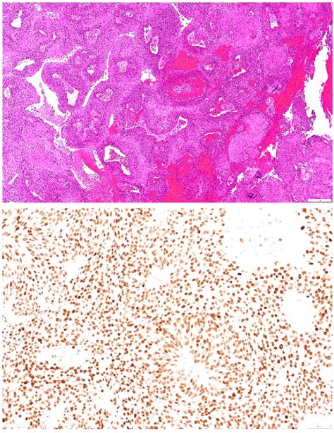 Above Hematoxylin And Eosin Staining Showing Villous Architecture With