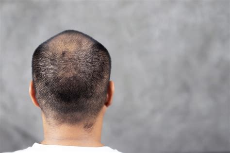 Factcheck Are Bald Men At Greater Risk Of Severe Coronavirus Illness