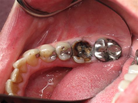 Dental Implant Or Root Canal Cost And Value Comparison Ramsey Amin Dds