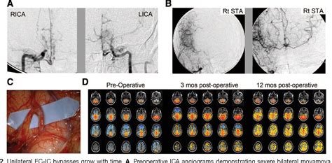 Figure 2 From Impact Of Extracranial Intracranial Bypass On Cerebrovascular Reactivity And