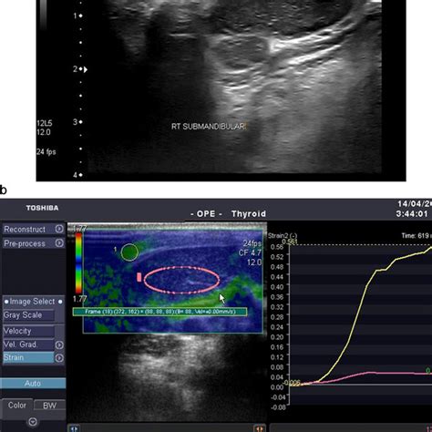 Pdf Ultrasound Elastography In Pathological Enlarged Cervical Lymph