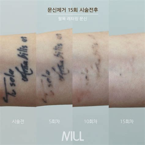 뮬피부과 문신제거는 센텀시티 뮬피부과 최근의 문신 색소는 하나의 레이저로는 완벽히 지우기 힘듭니다 뮬피부과의 다양한