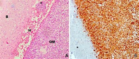 Brain Osteosarcoma Metastasis A Cerebral Hemorrhage In Tumor Download Scientific Diagram