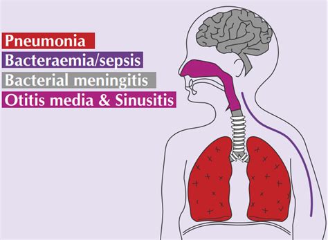 Pneumococcal Disease Pneumonia Vaccine Pneumosil®