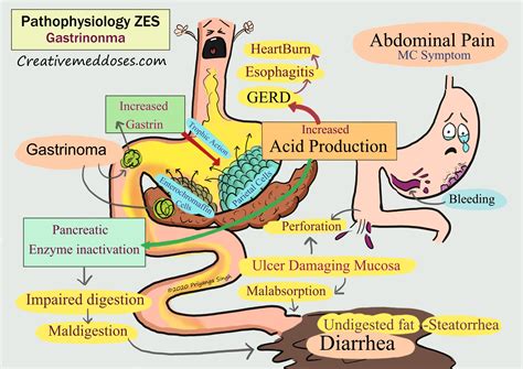 Zollinger Ellison Syndrome Pathophysiology Creative Med Doses
