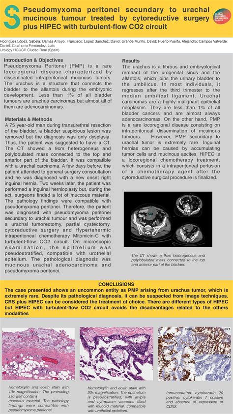 Pseudomyxoma Peritonei Secundary To Urachal Mucinous Tumour Treated By