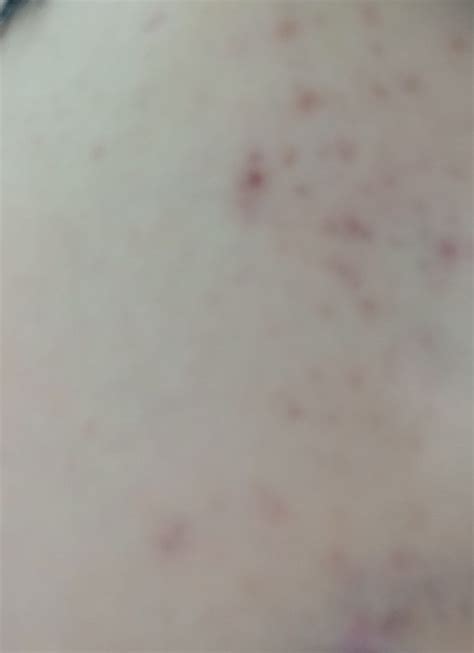 피부재생 크림을 쓰면 색소침착이 많이 개선될까요 지식in