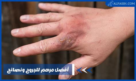أفضل مرهم للجروح ونصائح للتعامل مع الجروح منزليا موقع الفصيح