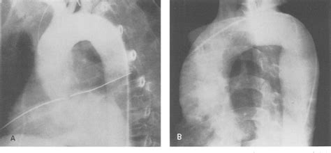 Angiographic Evaluation Of The Ductus Diverticulum Semantic Scholar
