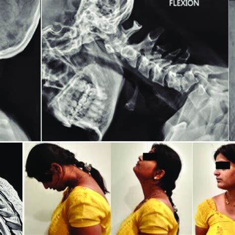 A Magnetic Resonance Imaging At Presentation Showing C5 C6