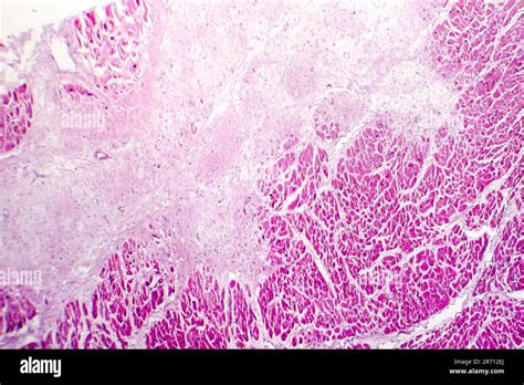 Acute Myocardial Infarction Histology Of Heart Tissue Light