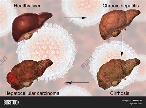 Liver Disease Image Photo Free Trial Bigstock