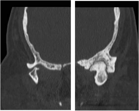Ct Scan Showing Hyperplastic Bone Formation Download Scientific Diagram