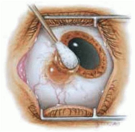 Surgical Management Of Conjunctival Tumors Ento Key