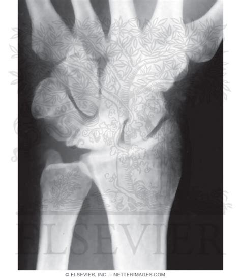 Radiograph In Kienböck Disease