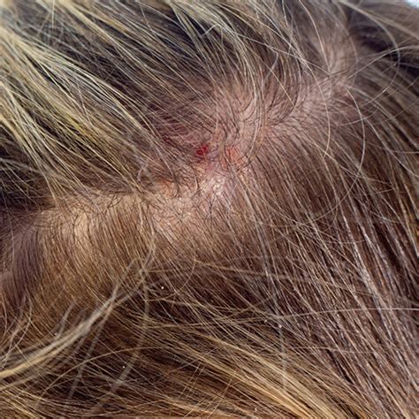 Treatments For Dissecting Cellulitis Of The Scalp Nyc Linkov Hair Surgery