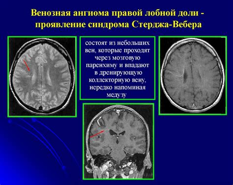 Лучевая диагностика КТ и МРТ заболеваний сосудов головы сосудистые