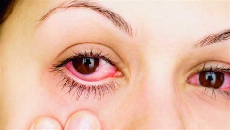 Conjuntivitis Infecciosas Bacterial Y Viral Síntomas Causas Y