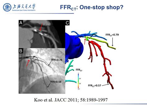 涂圣贤canffr Be Computed From Coronary Imaging 严道医声网