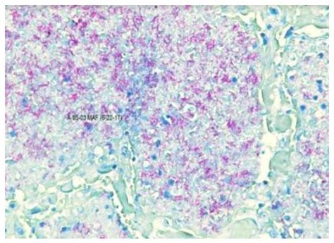 Afb Ziehl Neelsen Histology Staining Kits 45 Off