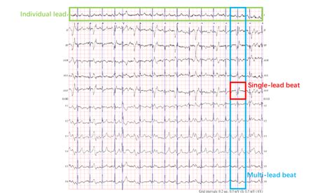 One Record With Multiple Leads Containing Several Premature Ventricular