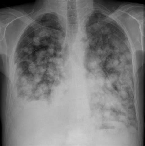 Cxr Case 041 • Litfl • Chest X Ray Self Assessment Quiz