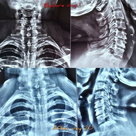 Drsubrat Kumar Barik On Linkedin Here We Can See The Difference In The X Ray How The Alignment