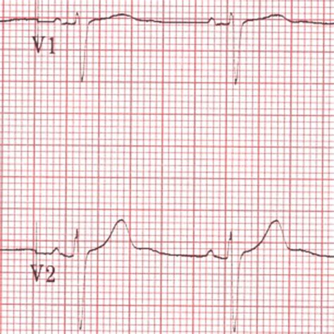 Normal Electrocardiogram Download Scientific Diagram