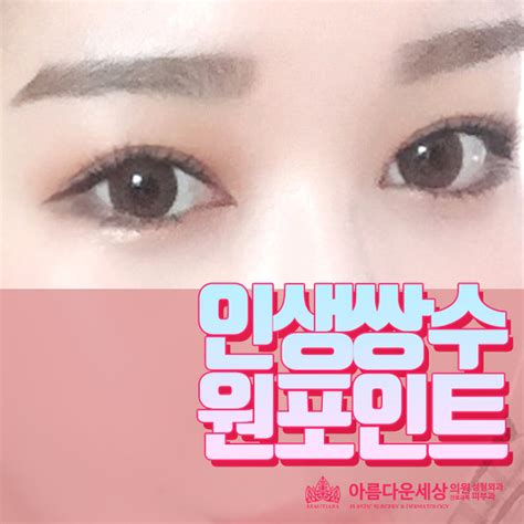 쌍수 절개 재수술 후기 쌍수후기 쌍수 눈매교정 눈재수술 눈재수술 후기 쌍꺼풀 재수술 잘하는 병원 … 광고게시판 발품미녀♥[네티즌★성형] 100