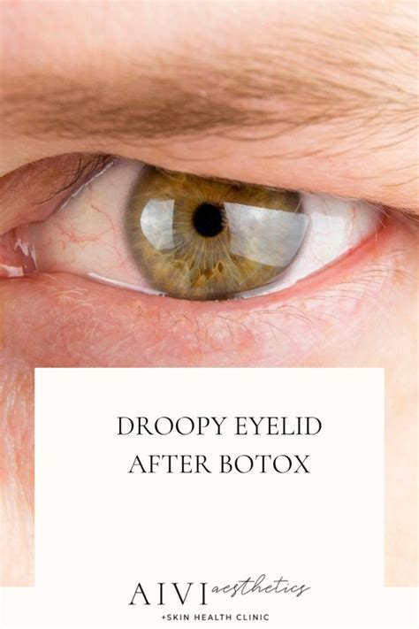Droopy Eyelid After Botox Droopy Eyelids Botox Botox Eyes