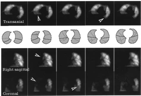 Creation Of A Three Dimensional Model Of Human Segmental Lung Anatomy Ajr