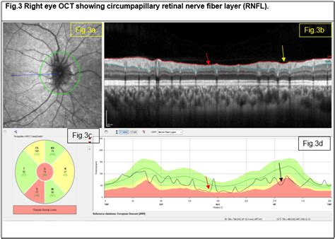 Spark Imagewise 67 Optic Disc Drusen With Retinal Nerve Fiber Layer