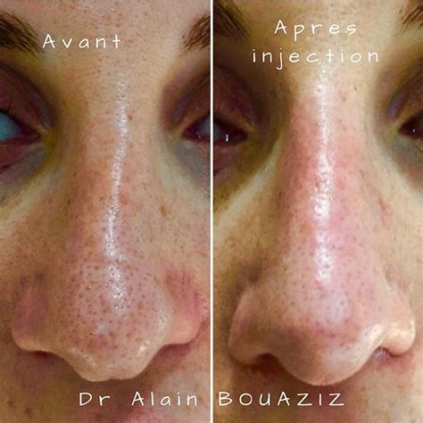 Rhinoplastie secondaire médicale par injection dacide hyaluronique