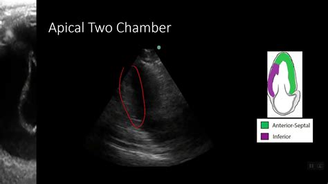 Point Of Care Echo Regional Wall Motion Abnormalities Youtube