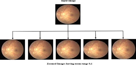 Figure From EfficientNet Based Diabetic Retinopathy Classification Using Data Augmentation